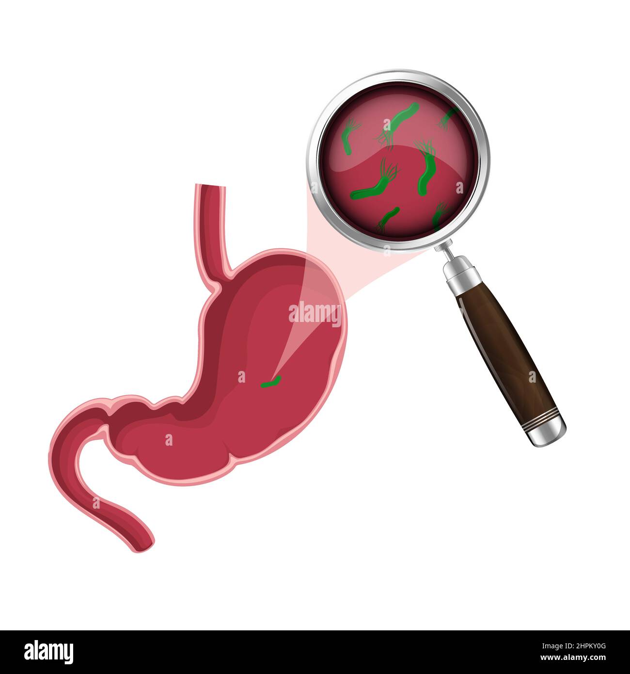 Helicobacter pylori bacteria. stomach with Peptic ulcer disease, and ...