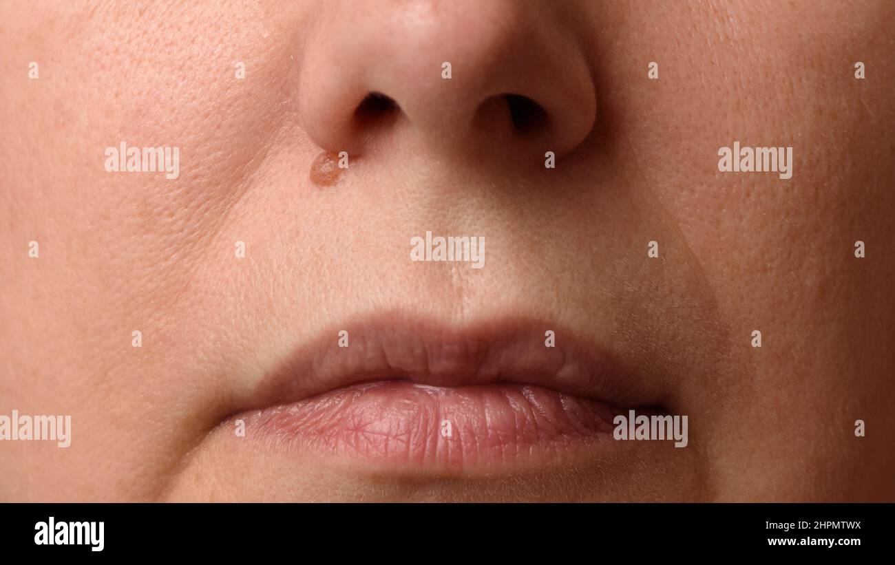 Closeup of mole or nevus under nose on woman face. Concept of timely ...