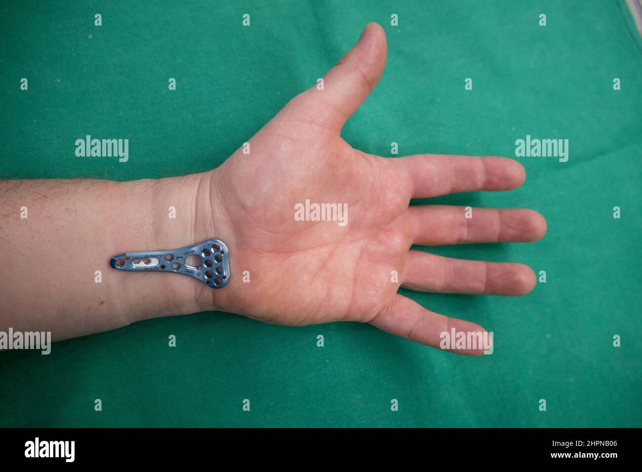 an explanted surgical blue titanium radius plate lies on the wrist ...