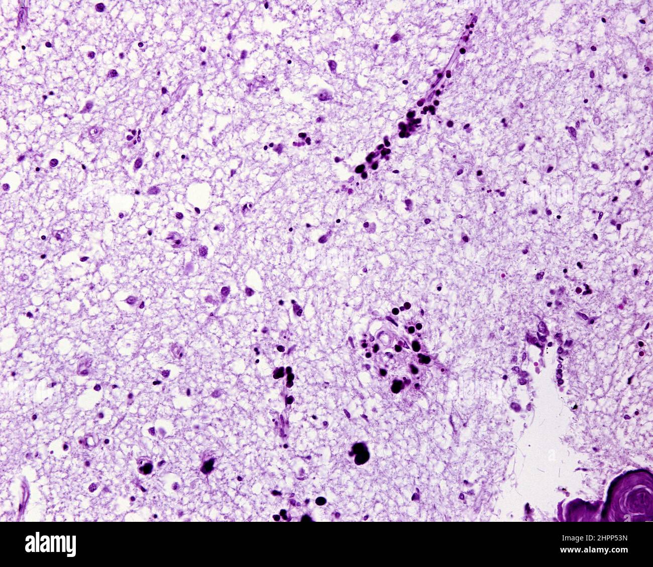 Calcifications in habenular commissure, light micrograph Stock Photo ...