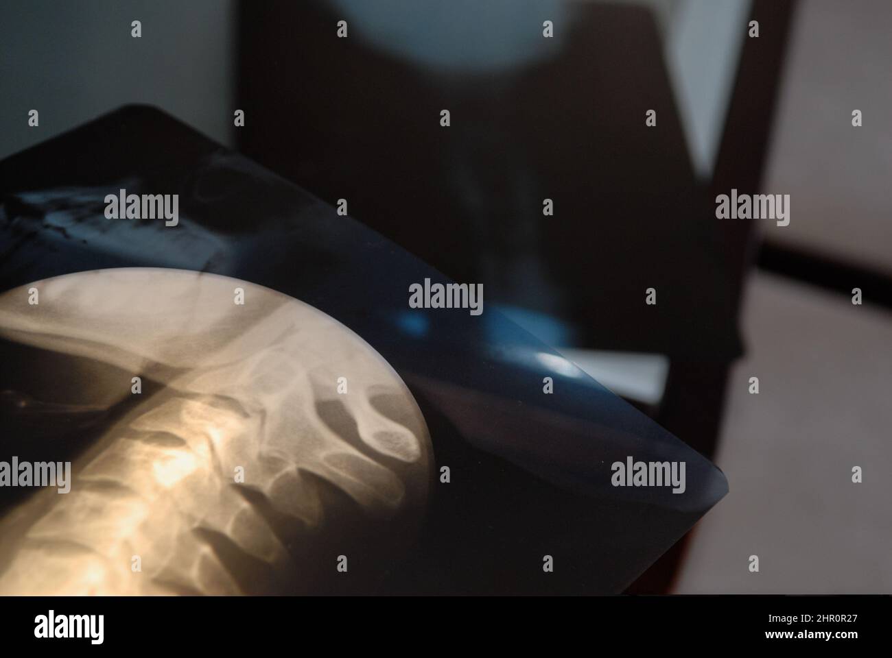 Male neck x-ray radiography on doctor table Stock Photo - Alamy
