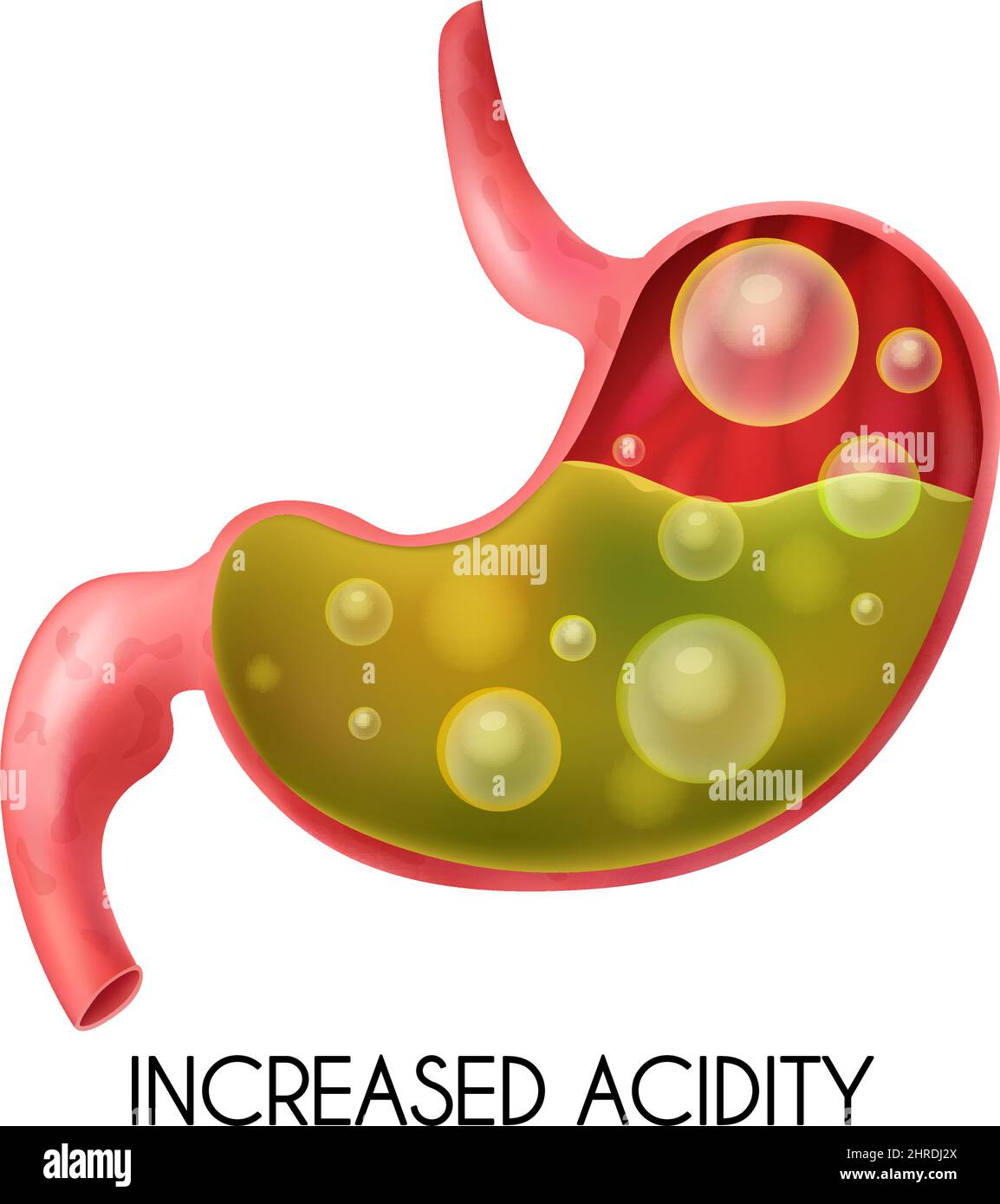 Human internal organ stomach with increased acidity on white background ...
