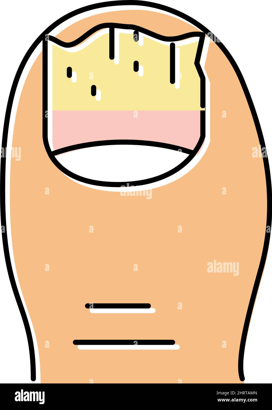 onychomycosis nail disease color icon vector illustration Stock Vector ...