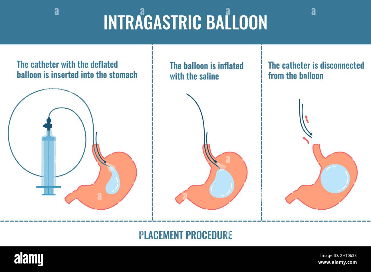 Gastric catheter hi-res stock photography and images - Alamy
