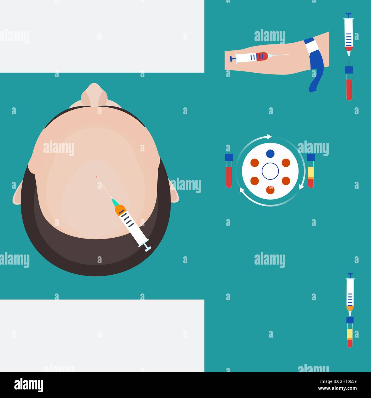 PRP hair treatment, illustration Stock Photo - Alamy