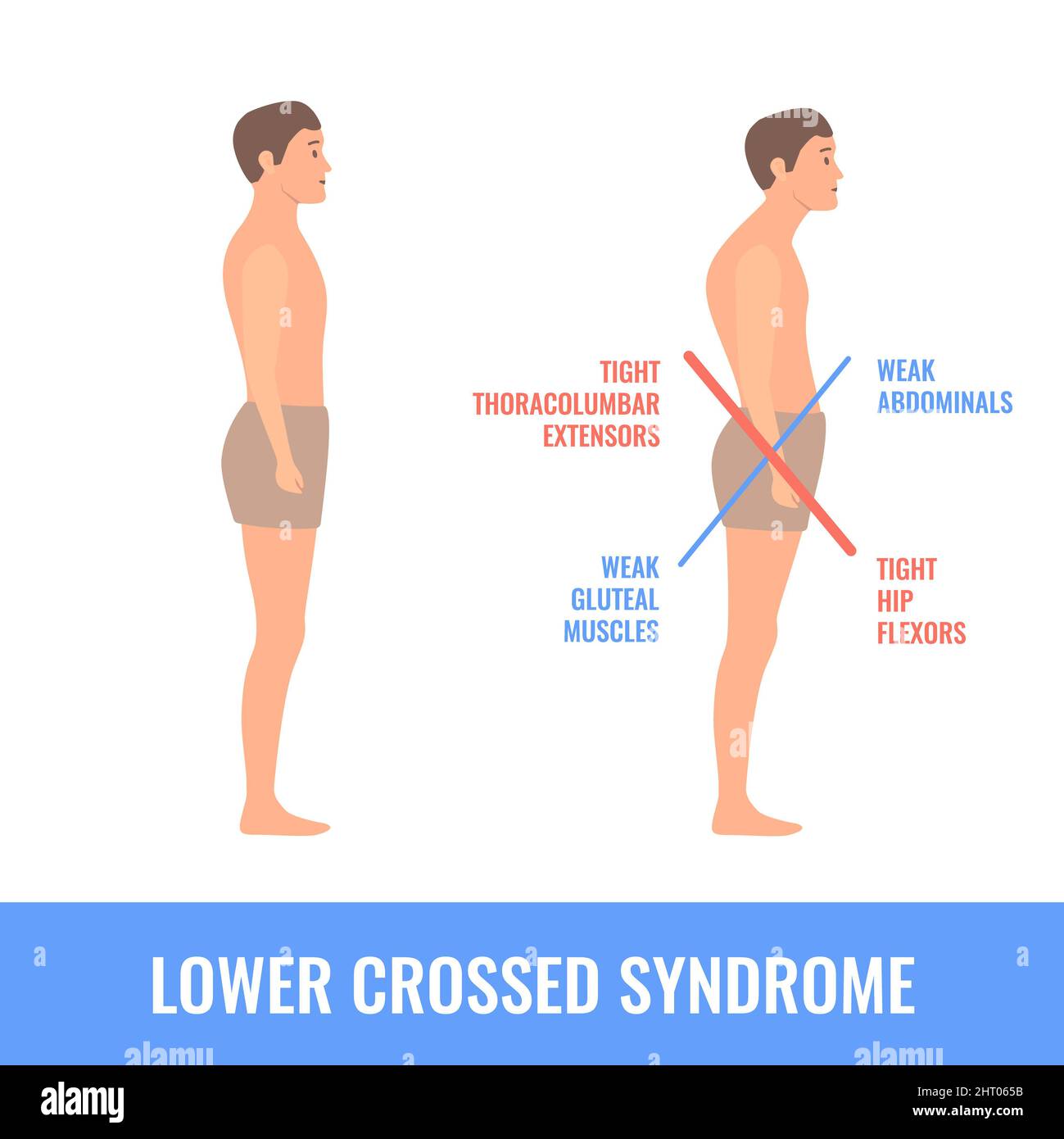Lower crossed syndrome, conceptual illustration Stock Photo - Alamy