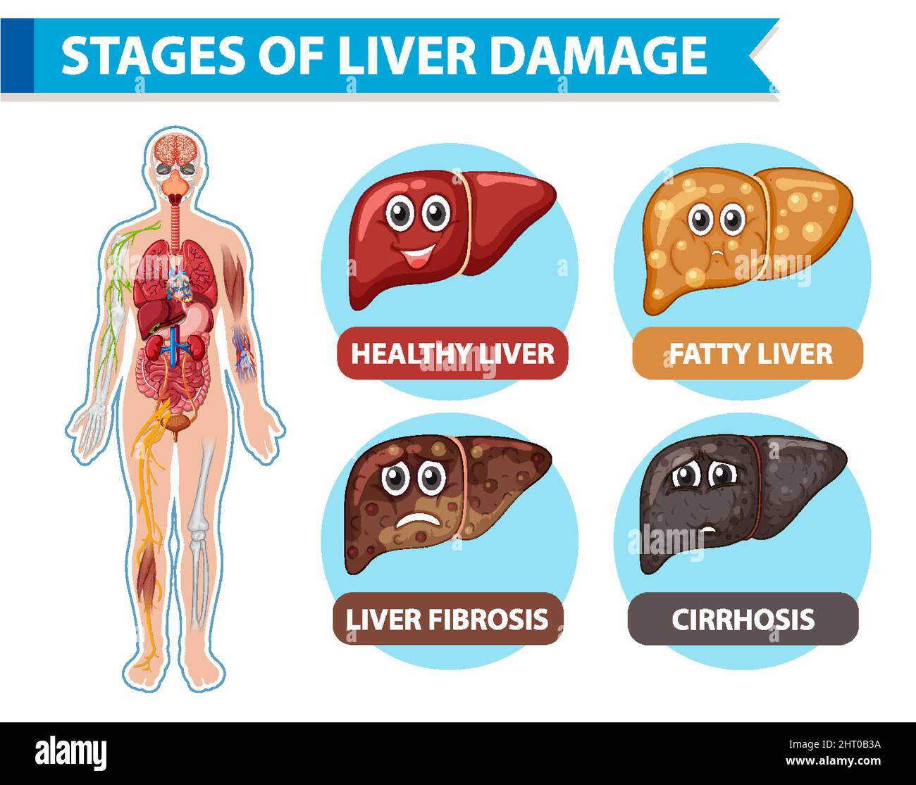 Diagram showing stages of liver damage illustration Stock Vector Image ...