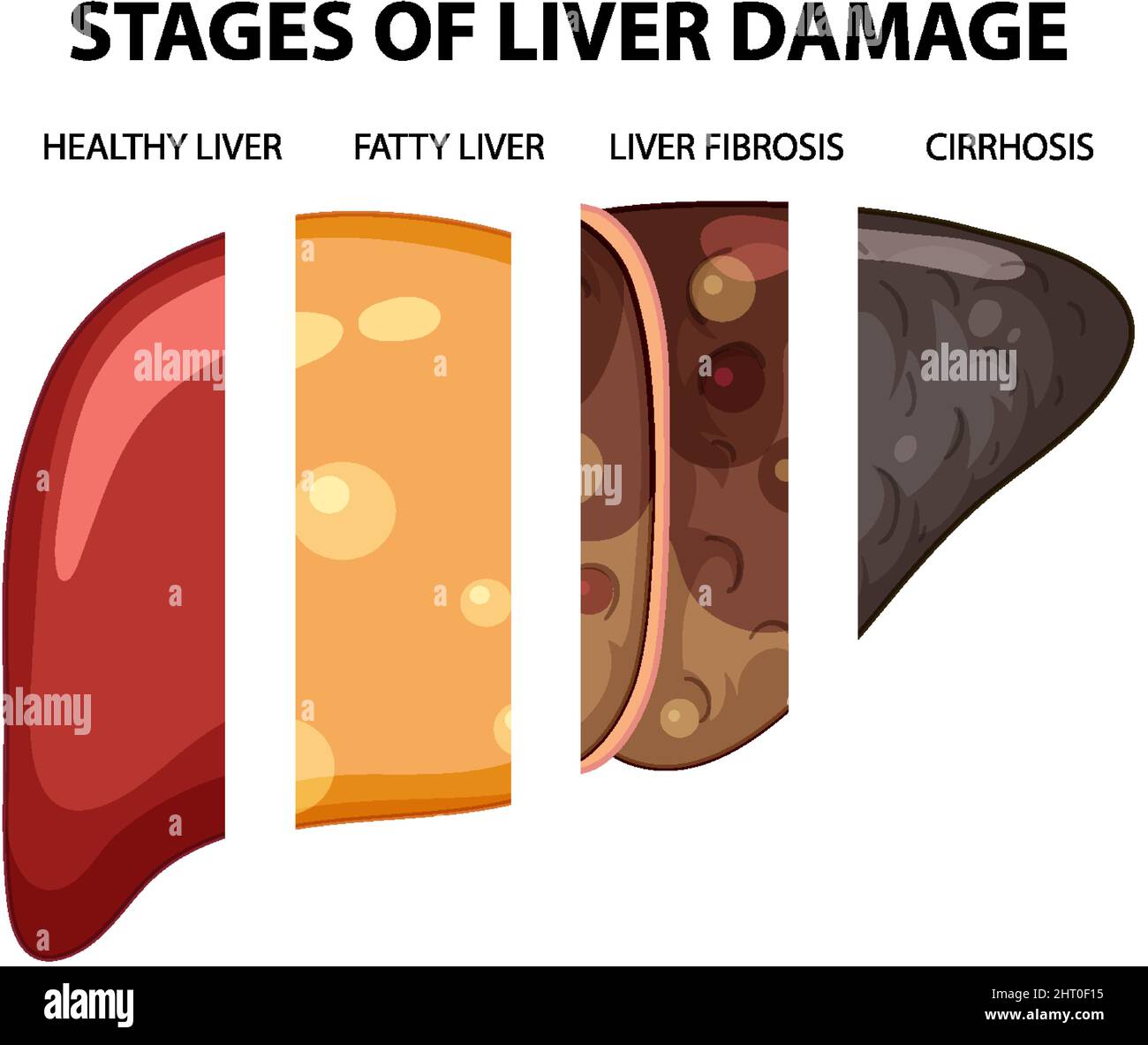 Diagram showing stages of liver damage illustration Stock Vector Image ... Diagram showing stages of liver damage illustration Stock Vector Image ...
