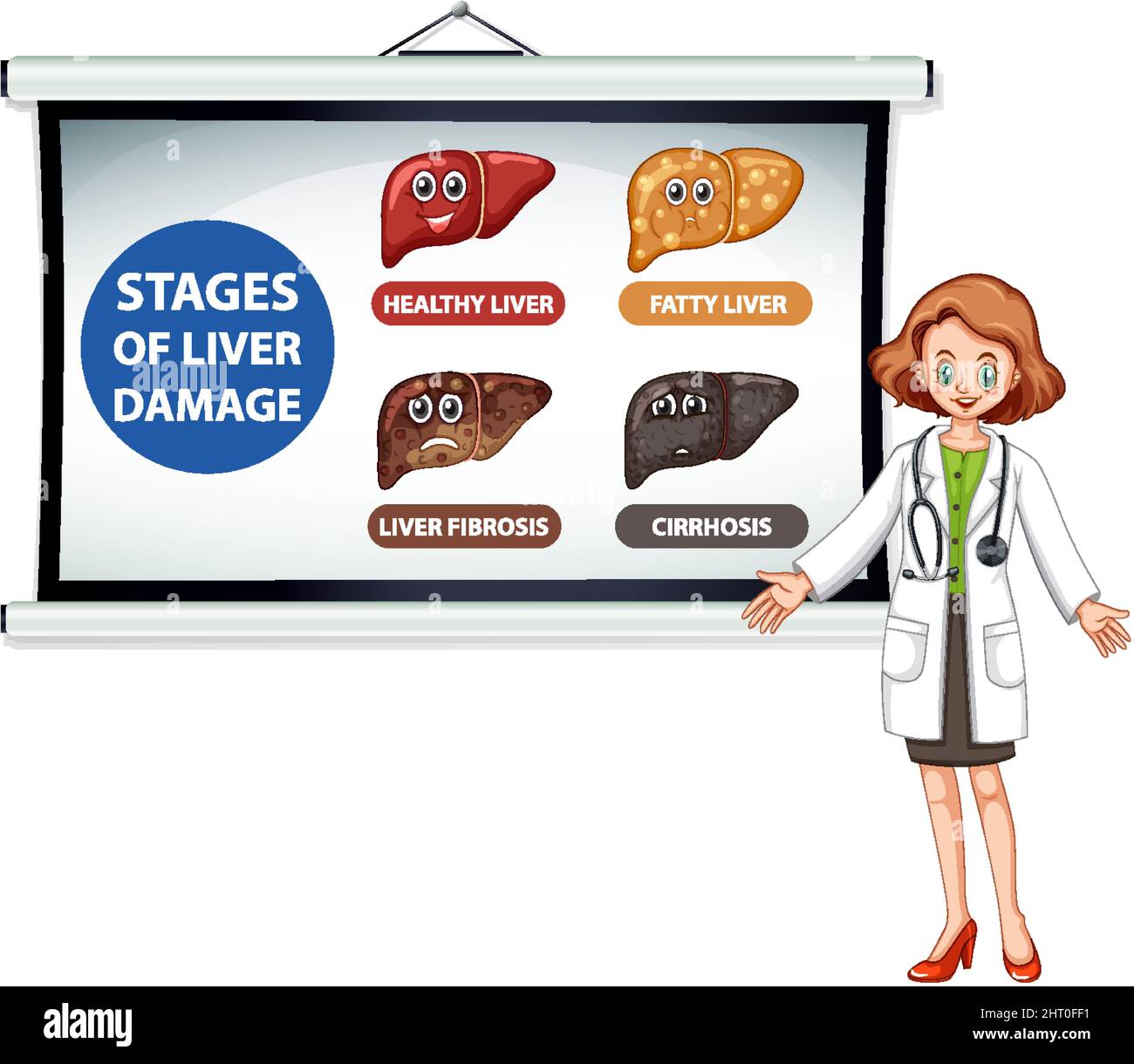 Diagram showing stages of liver damage illustration Stock Vector Image ...