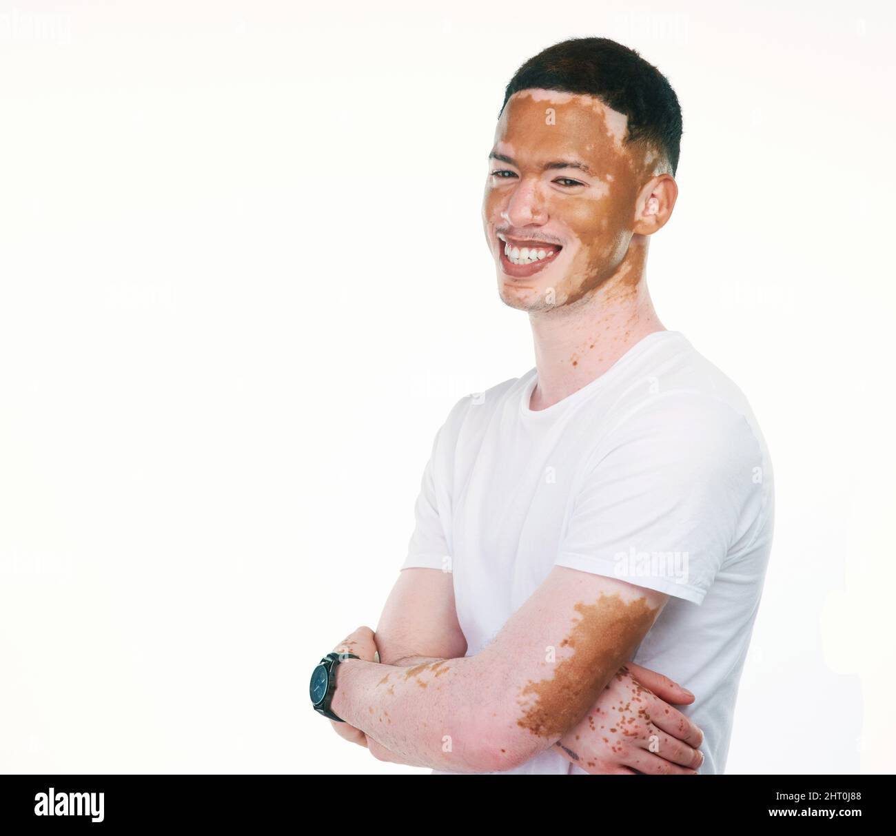 My skin doesnt define me. Portrait shot of a handsome young man with ...