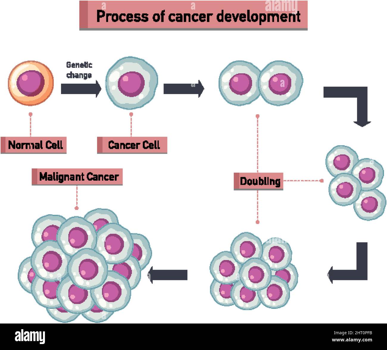 Process of cancer development infographic illustration Stock Vector ...