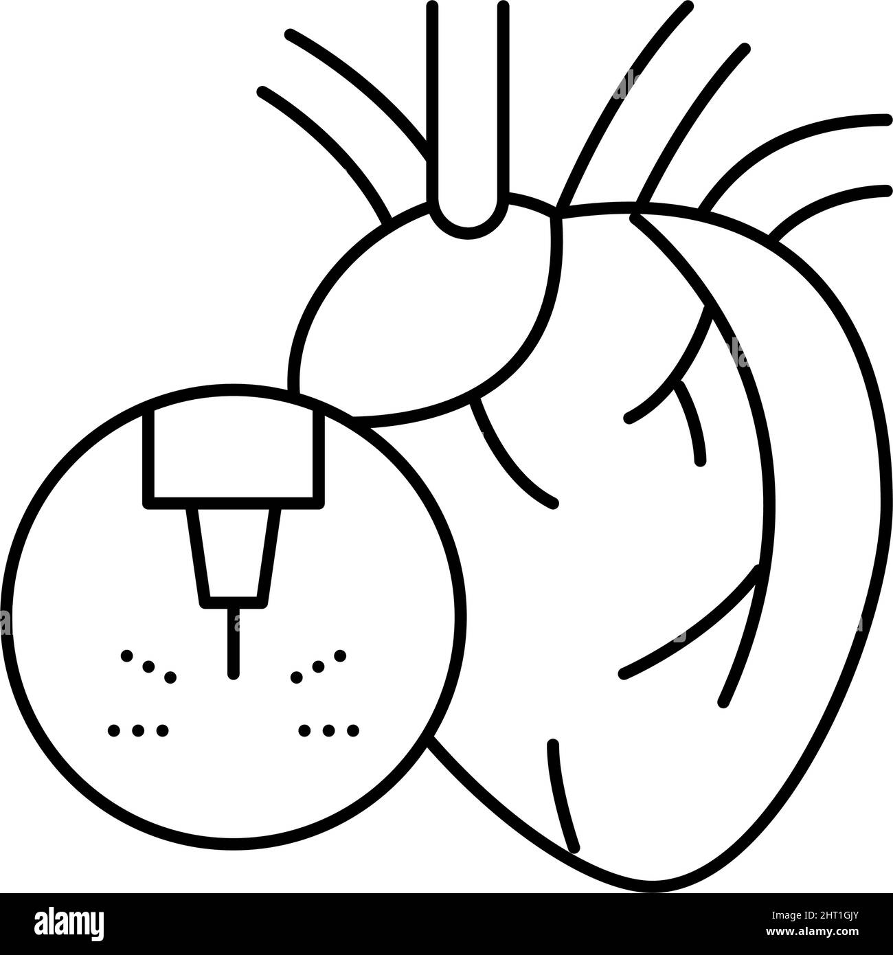 Laser heart surgery Black and White Stock Photos & Images - Alamy