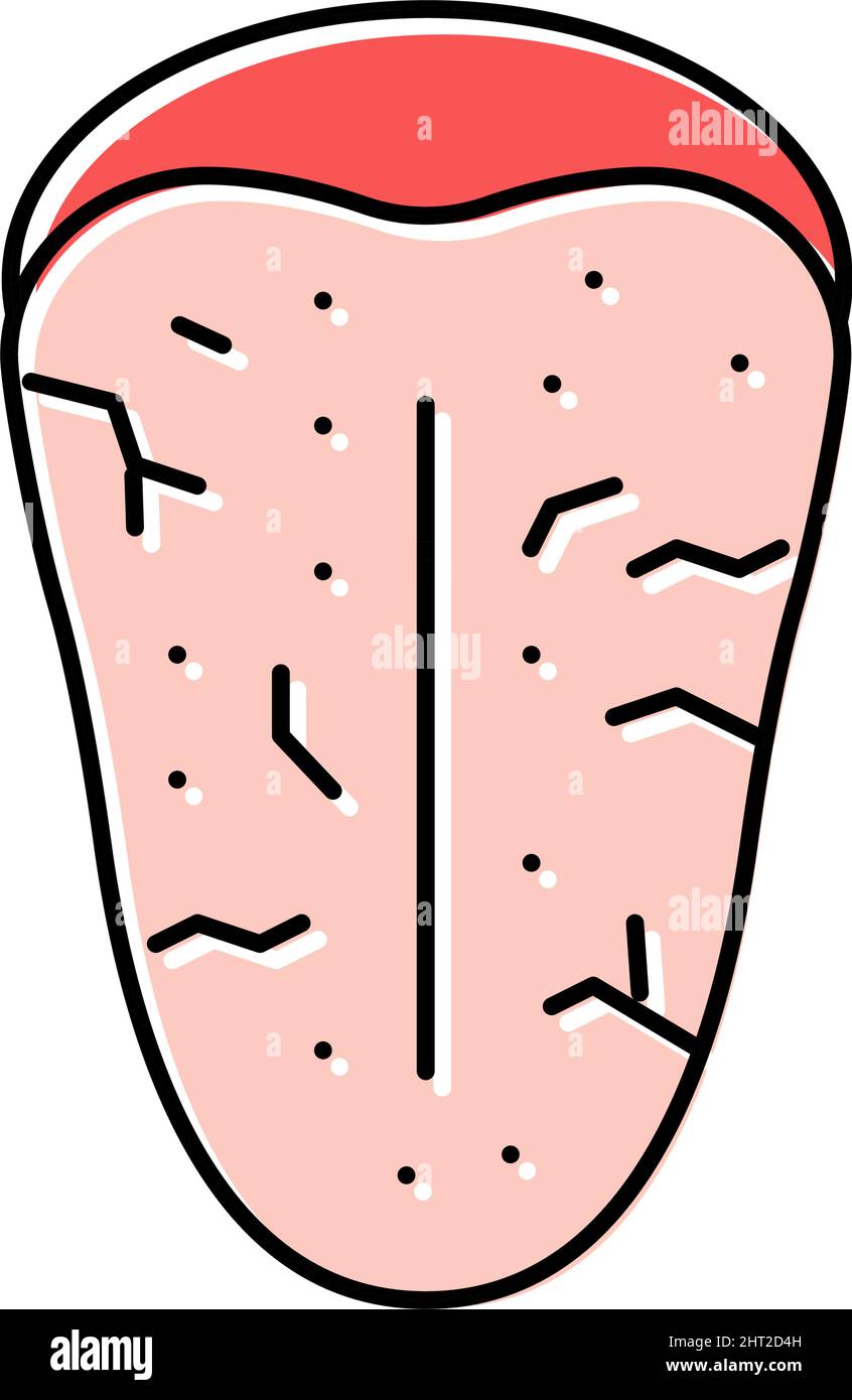 Sjogren’s syndrome hi-res stock photography and images - Alamy