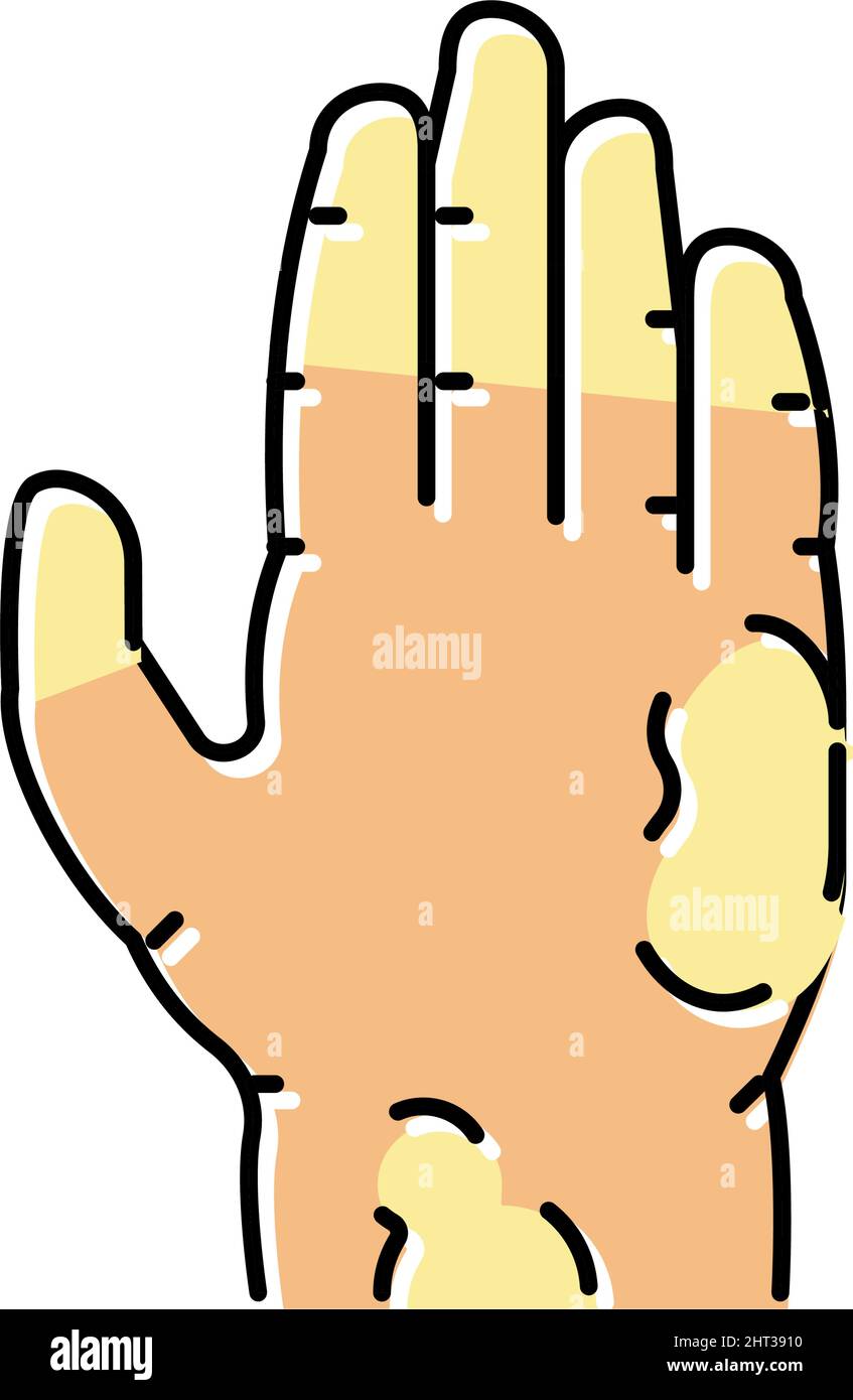 Scleroderma Skin Disease Color Icon Vector Illustration Stock Vector Image And Art Alamy