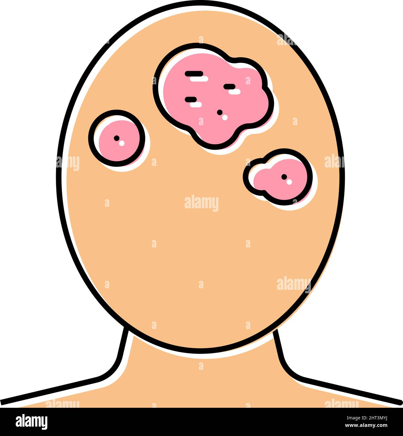 Seborrhoeic Dermatitis Skin Disease Color Icon Vector Illustration