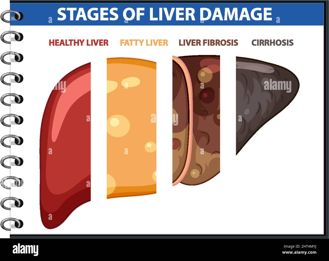 Diagram showing stages of liver damage illustration Stock Vector Image ...