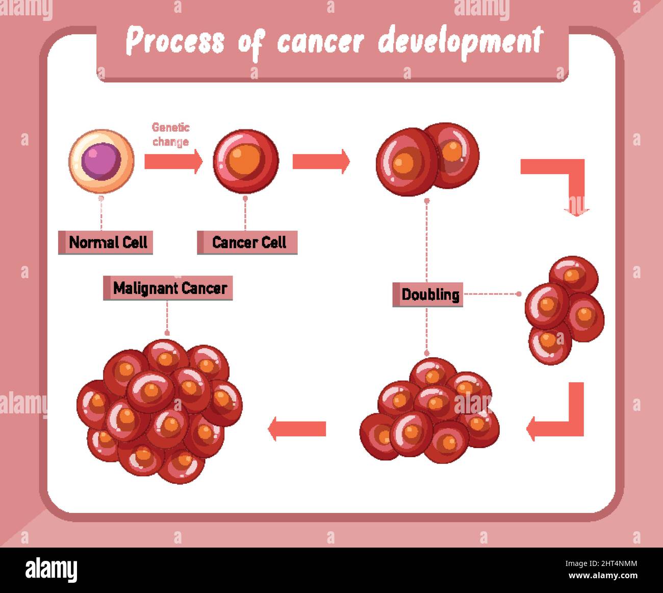 Process of cancer development infographic illustration Stock Vector ...