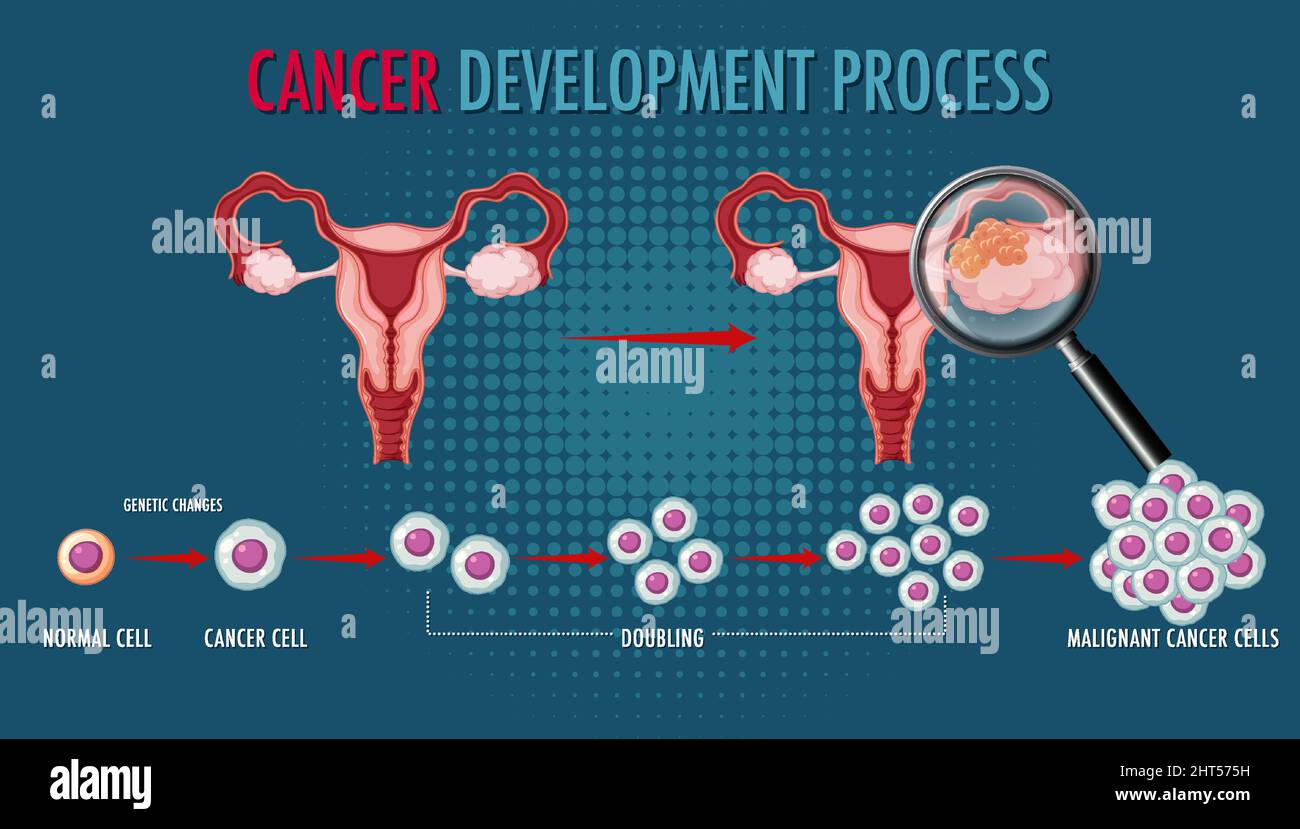 Cancer development process infographic illustration Stock Vector Image ...