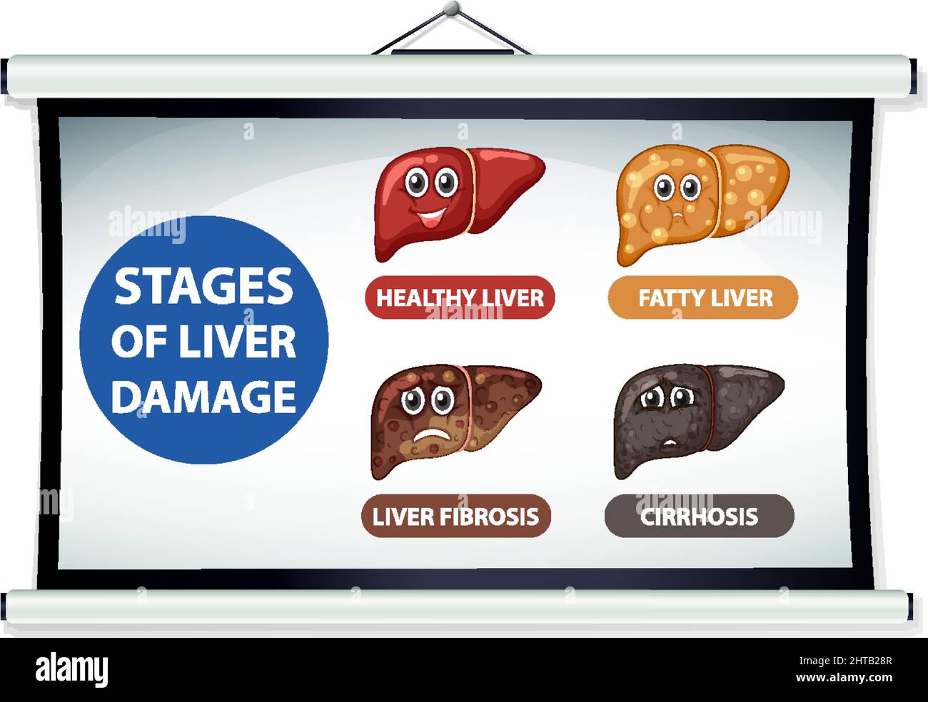 Diagram showing stages of liver damage illustration Stock Vector Image ... Diagram showing stages of liver damage illustration Stock Vector Image ...