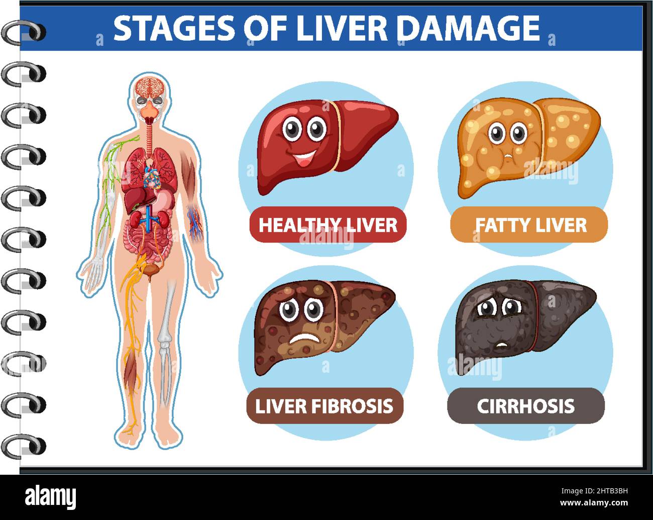Diagram showing stages of liver damage illustration Stock Vector Image ...