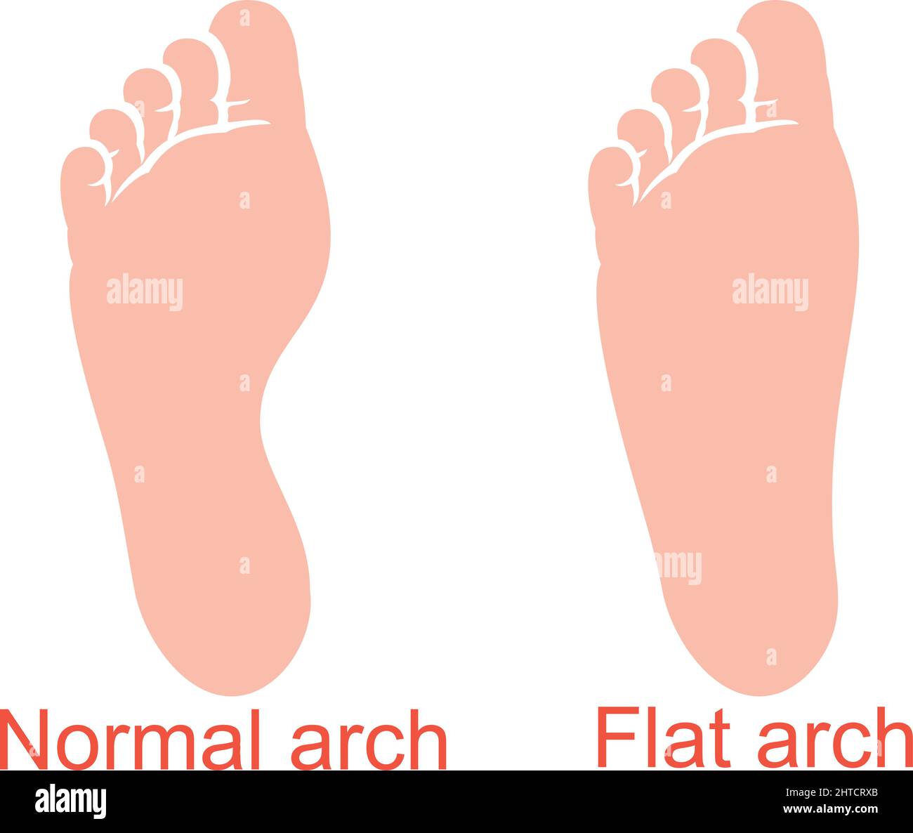 Normal and flat arch vector illustration Stock Vector Image & Art - Alamy