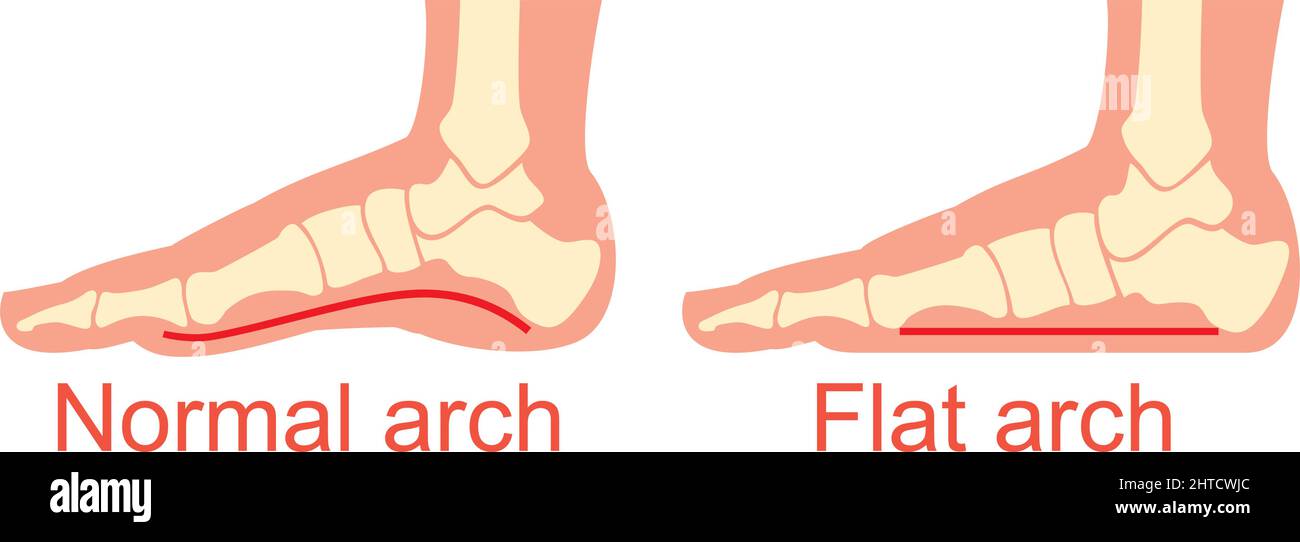 Human anatomy - flat and normal arch vector illustration Stock Vector ...