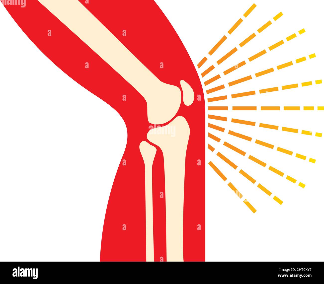 Hamstring injury Stock Vector Images - Alamy