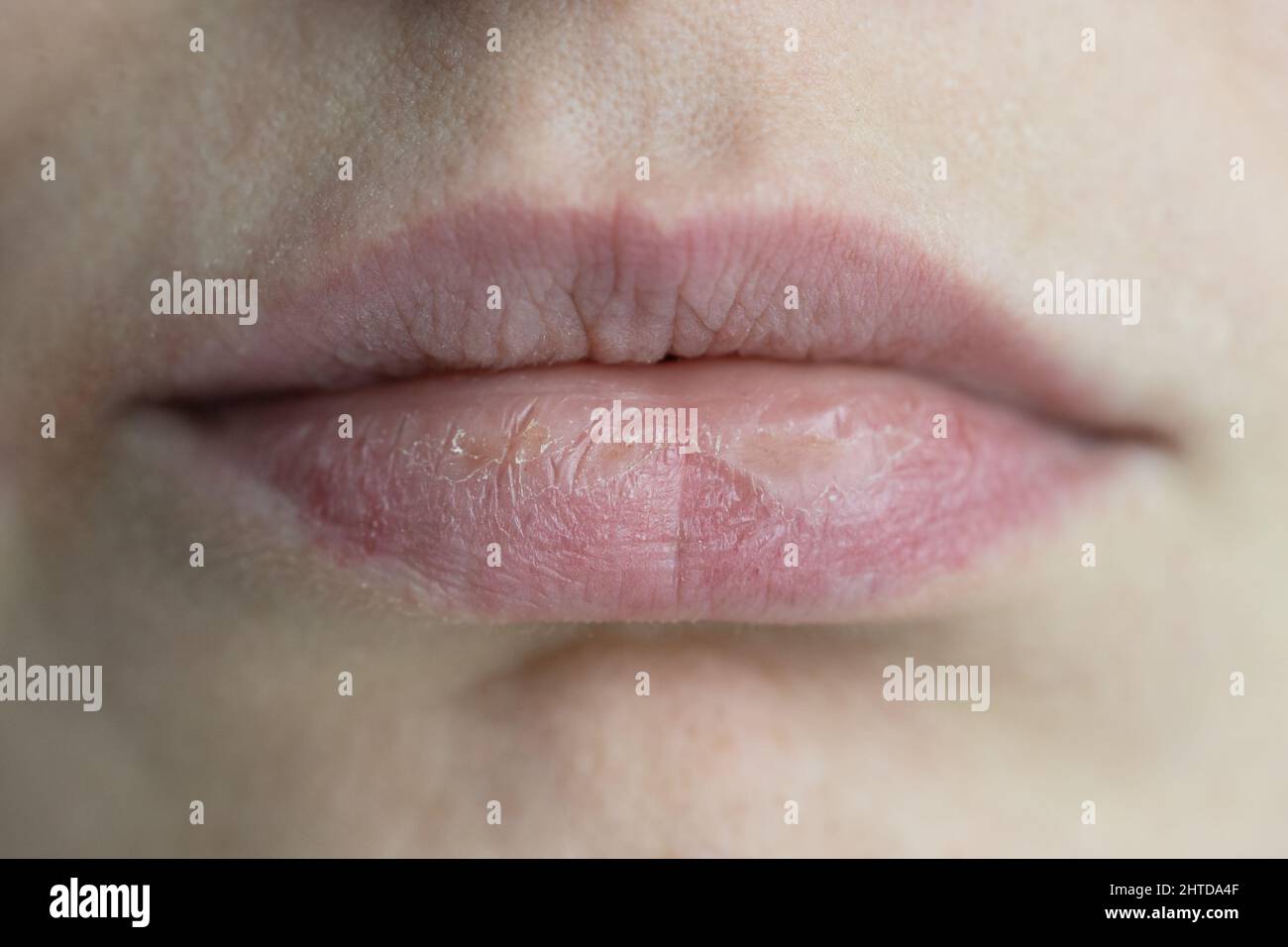 Closeup caucasian female face with brittle and dry chapped lips. Beauty ...