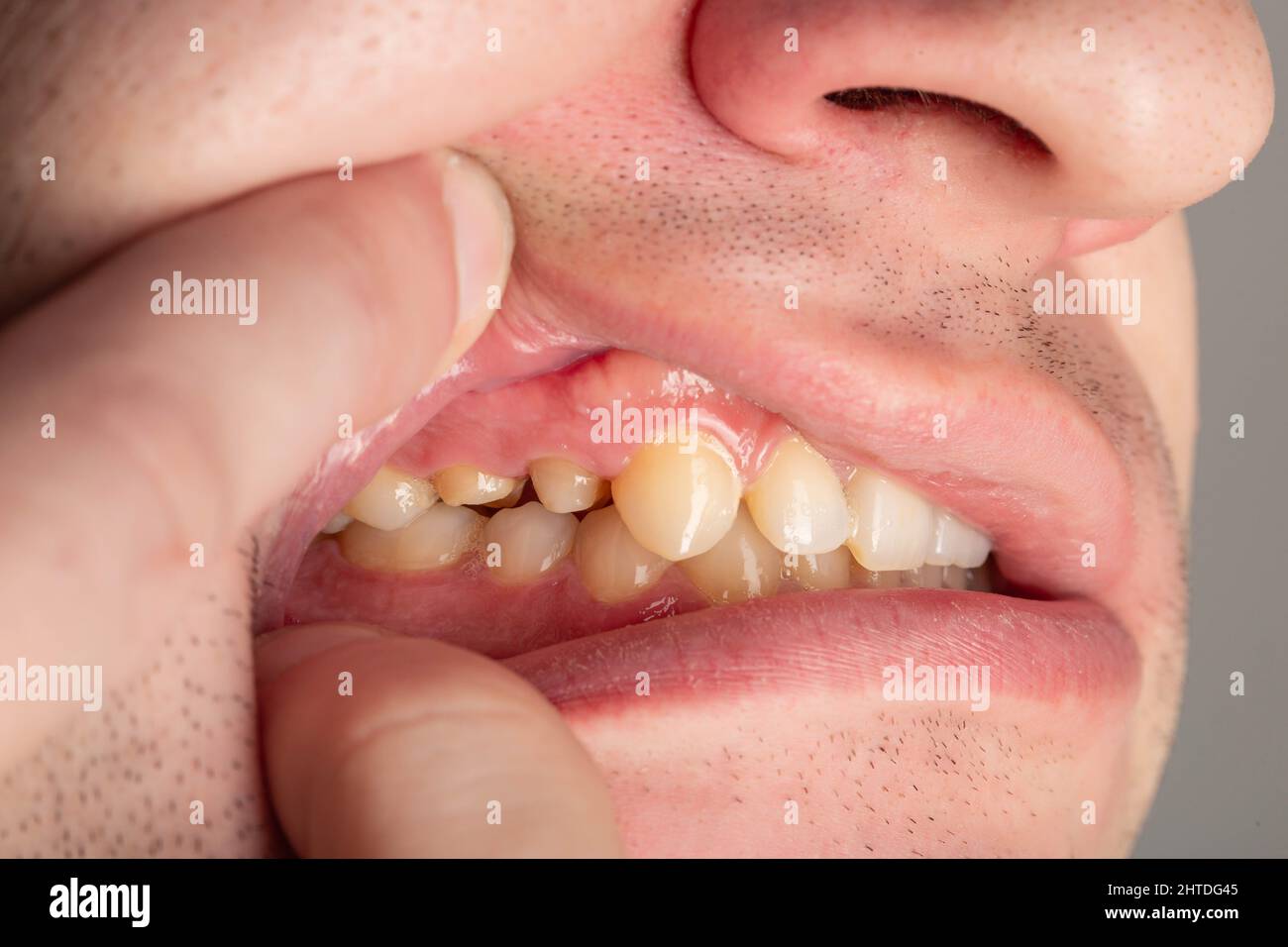 Ground prepared teeth before installing a porcelain fused-to-metal ...