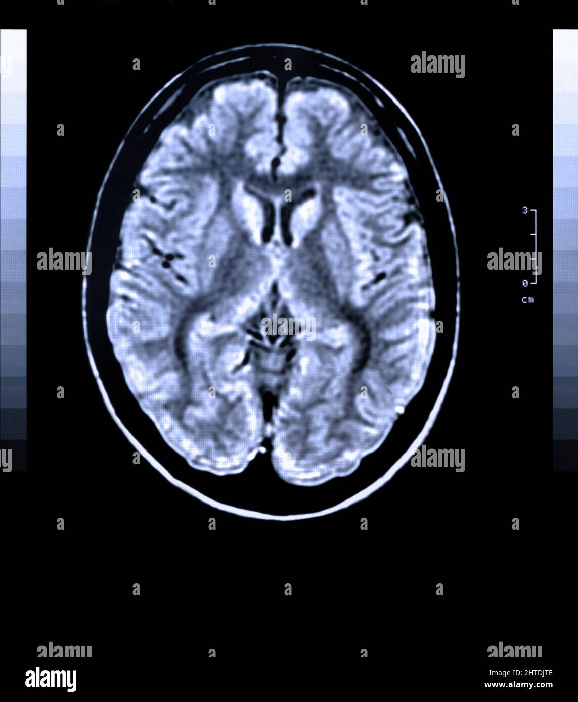 Illuminated MRI scan of a brain Stock Photo - Alamy