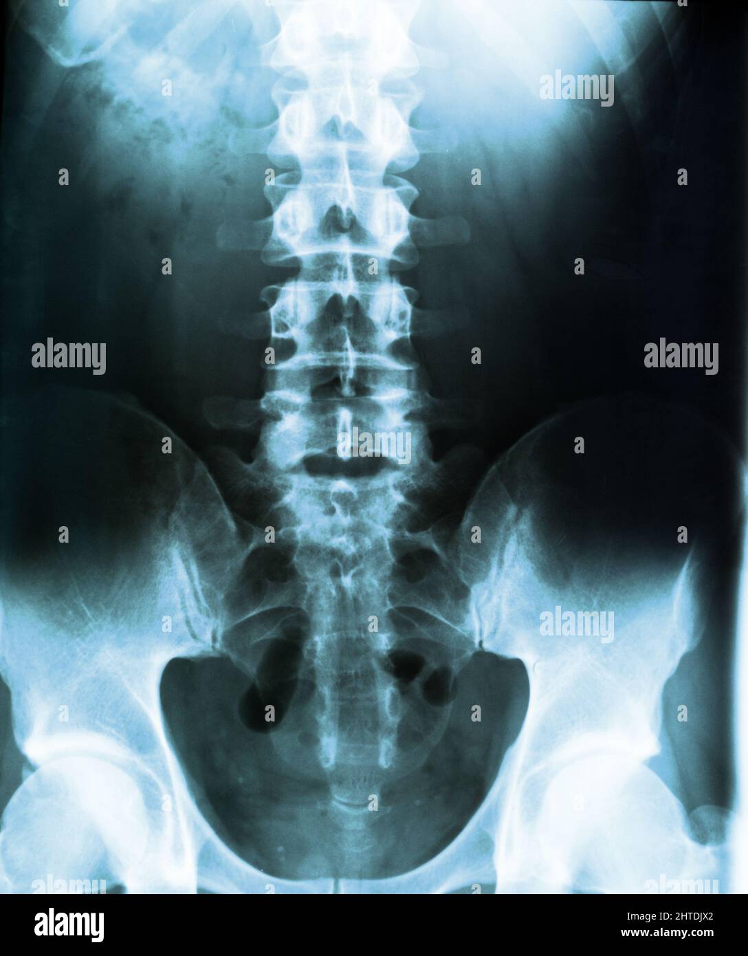 A vertical shot of a human spine x-ray image Stock Photo - Alamy