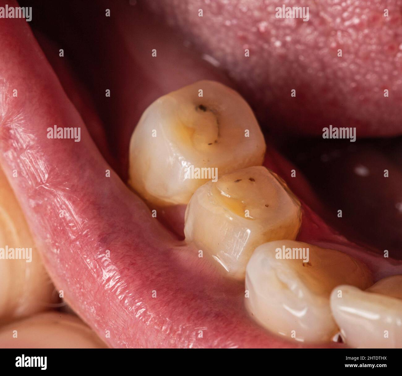 Crowned teeth. Preparation of teeth in dentistry for the installation ...