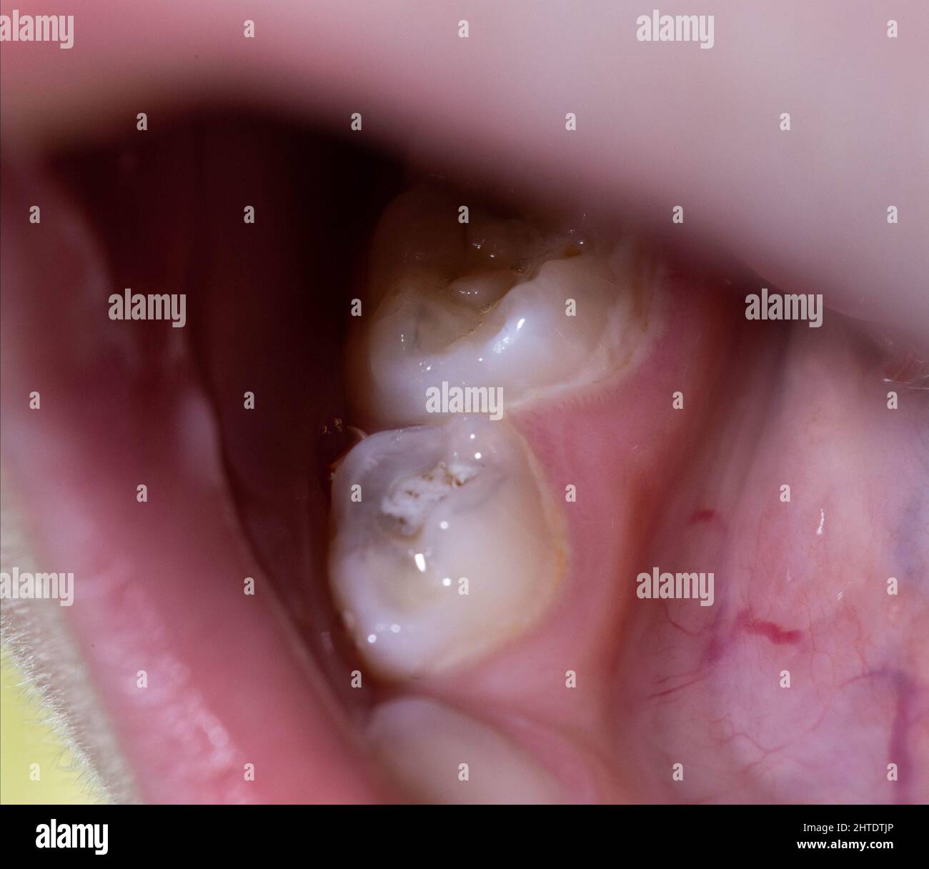 Caries on a baby's tooth, close-up. Concept of dental treatment for ...