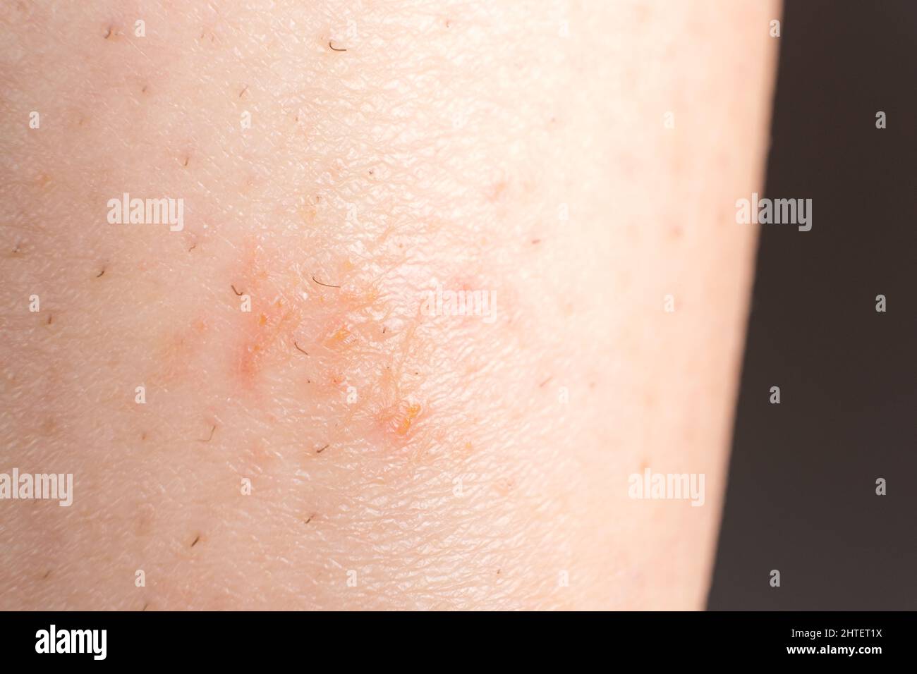 Streptoderma - dermatitis on human skin, red round spot, macro ...
