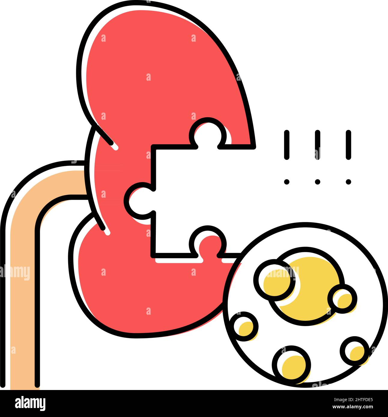 Uric acid stones hi-res stock photography and images - Alamy