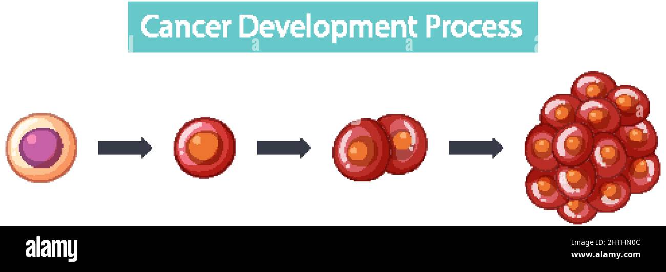 Process of cancer development infographic illustration Stock Vector ...