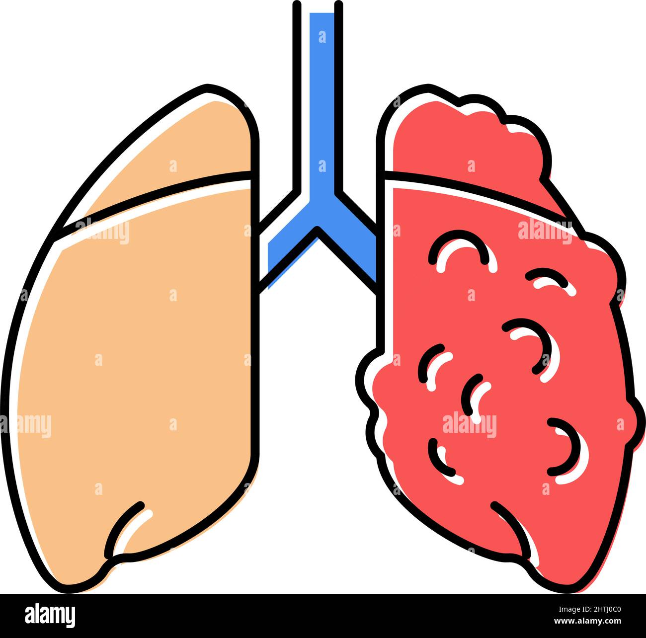 X ray respiratory distress syndrome Cut Out Stock Images & Pictures - Alamy