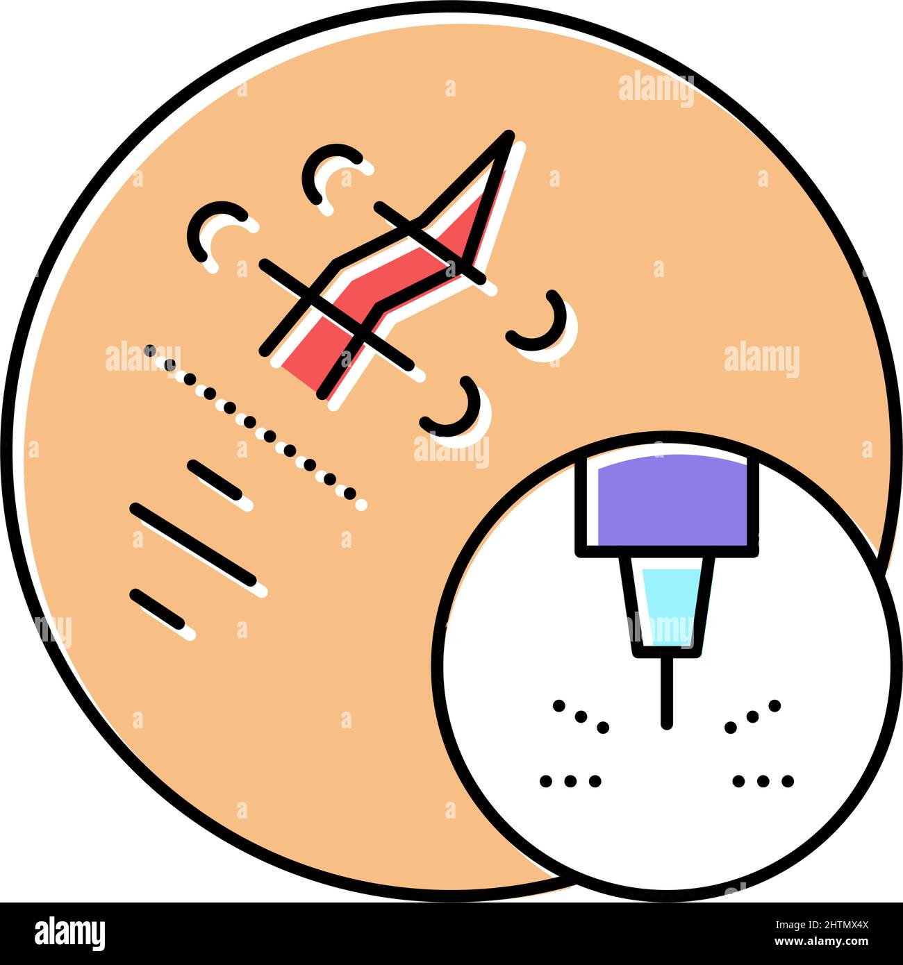 Removal vascular pathologies color hi-res stock photography and images ...