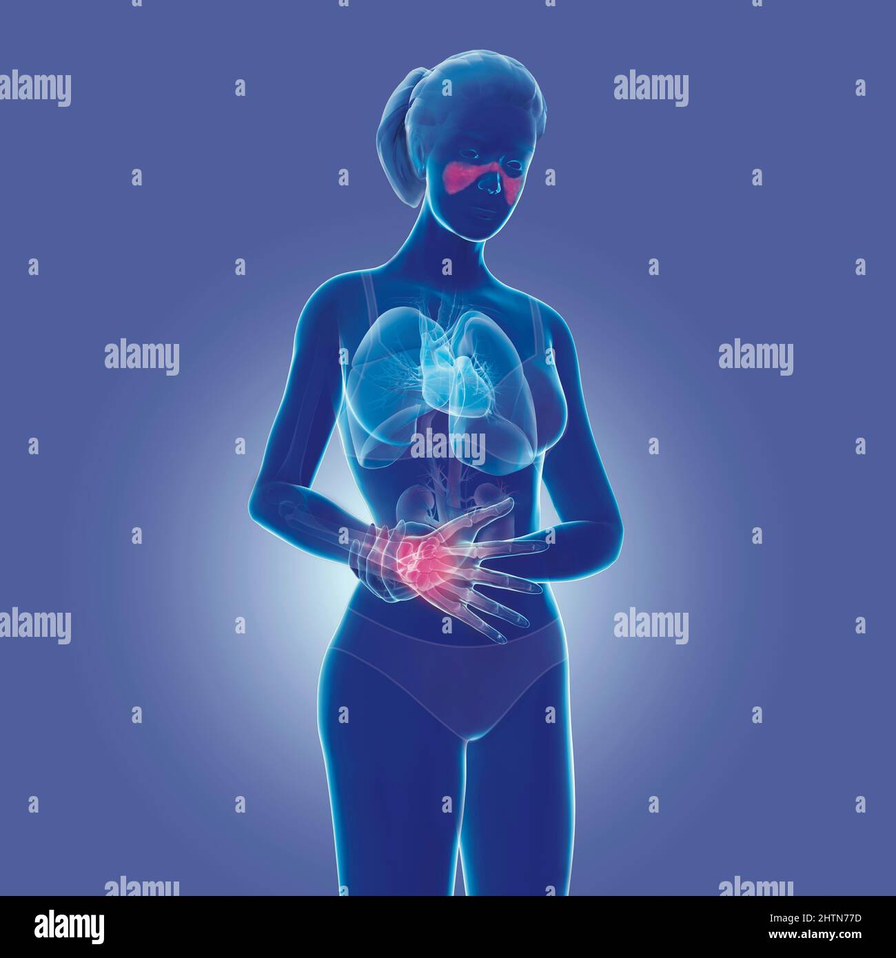 Organs affected by lupus autoimmune disease, illustration Stock Photo ...