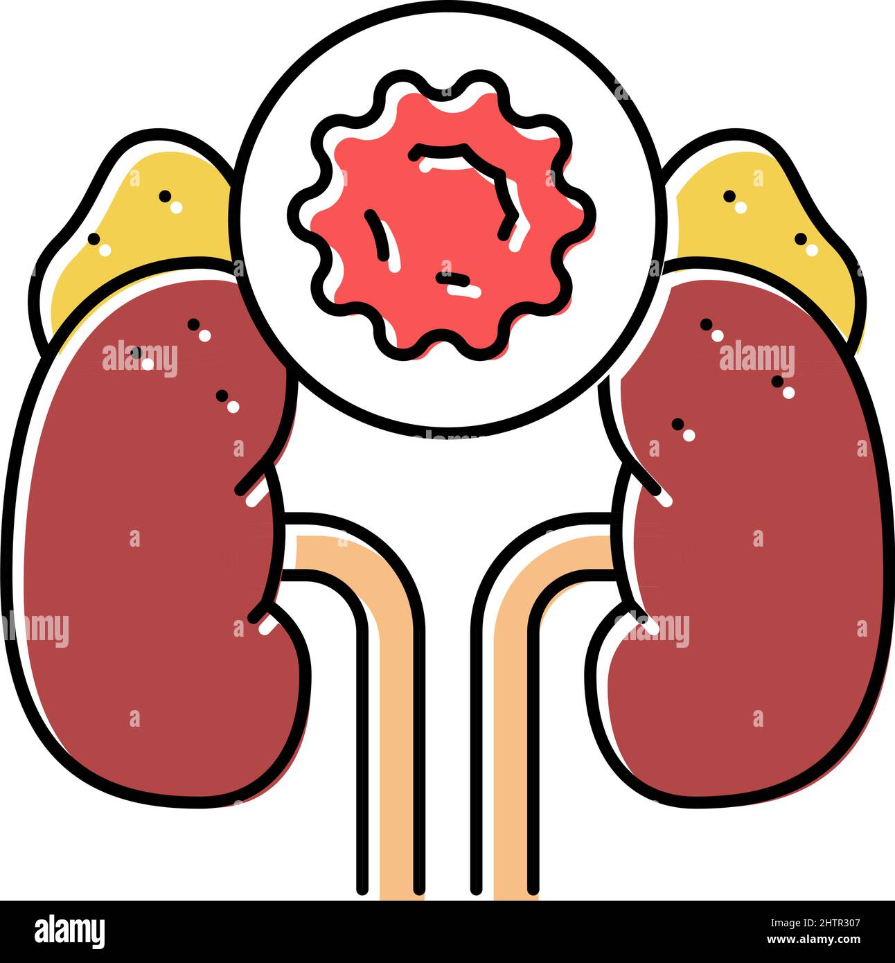 cushing cortisol syndrome color icon vector illustration Stock Vector ...