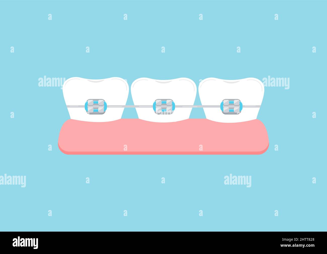 Clear brace Stock Vector Images - Alamy