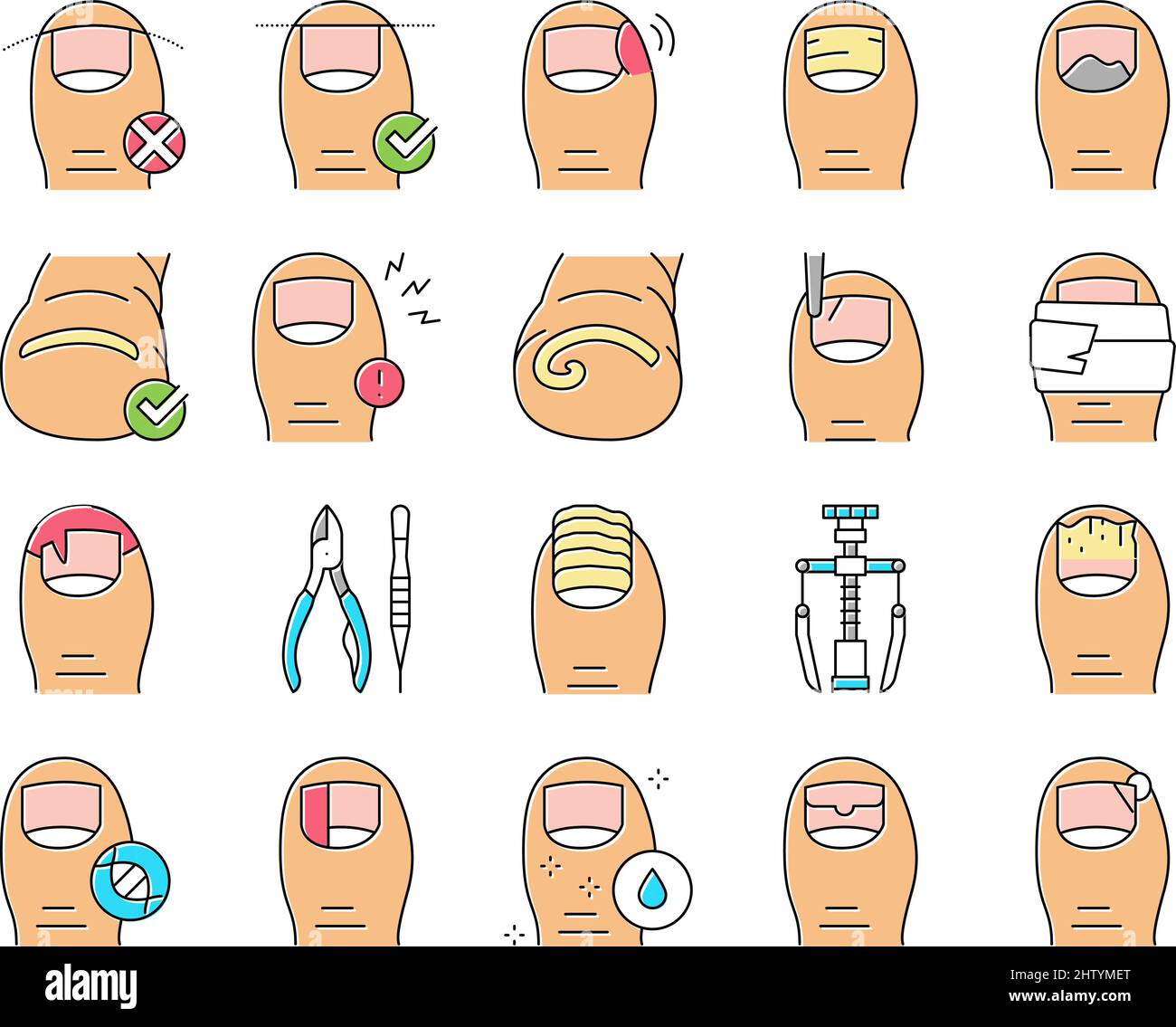 Ingrown Nail Disease Collection Icons Set Vector Stock Vector Image ...