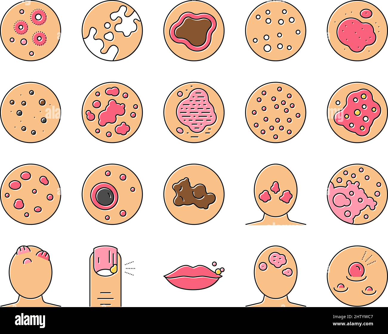 Chronic blistering skin disease color hi-res stock photography and ...