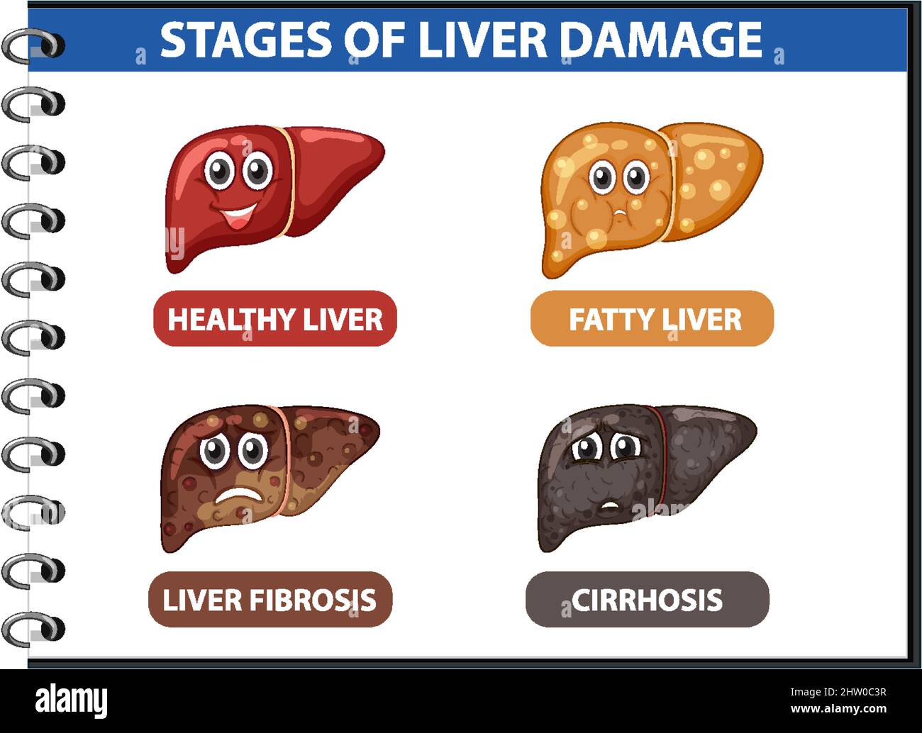 Diagram showing stages of liver damage illustration Stock Vector Image ...