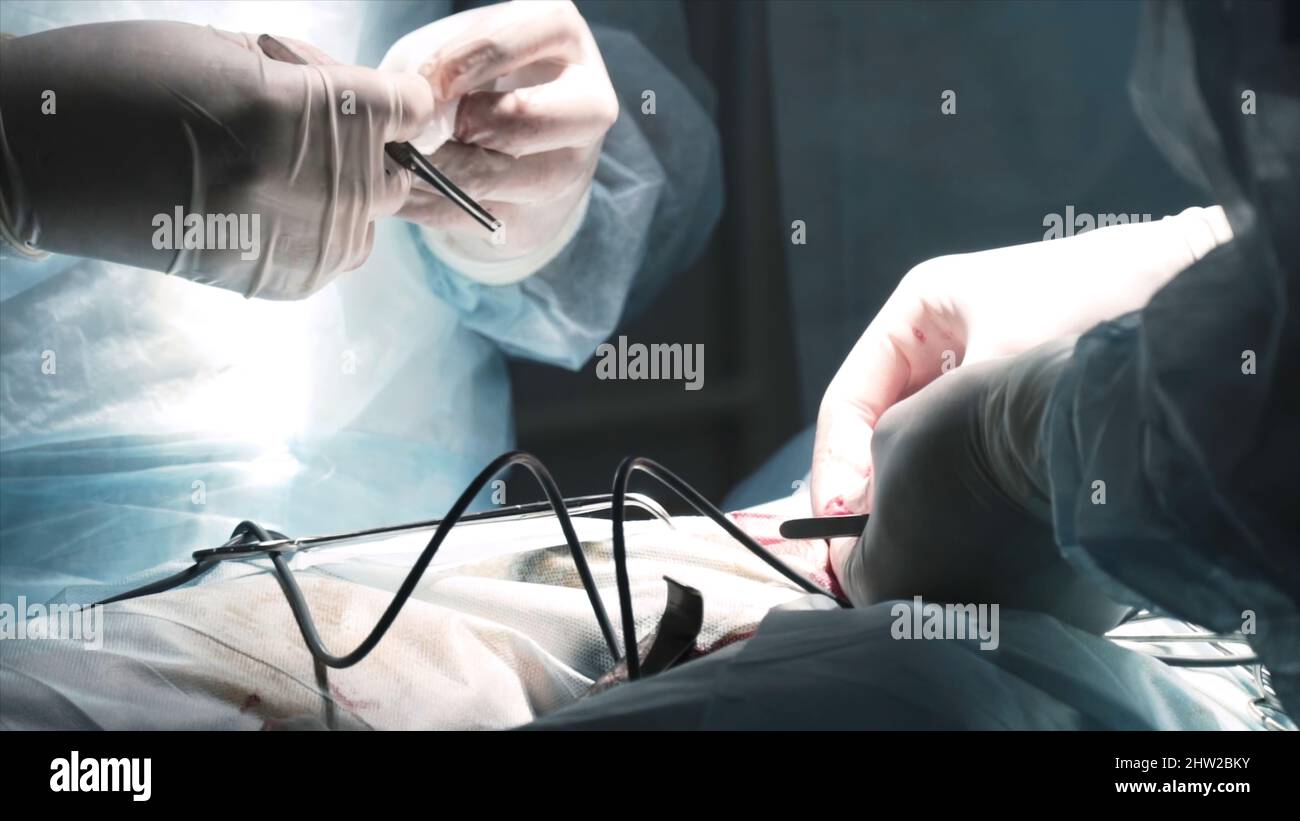 Surgeons performing operation under anesthesia. Action. Close-up ...