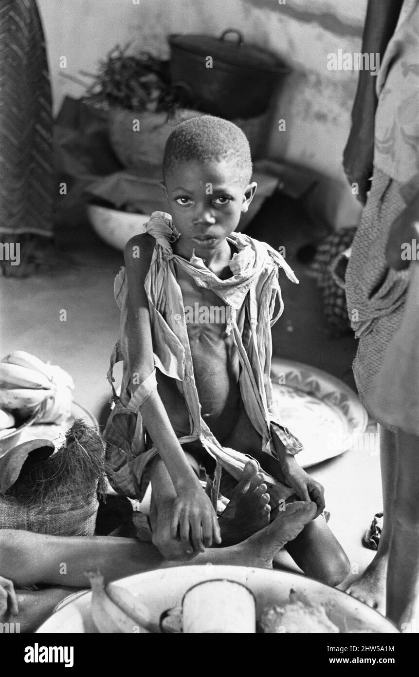 A staving child showing all the classic symptoms of malnutrition seen ...