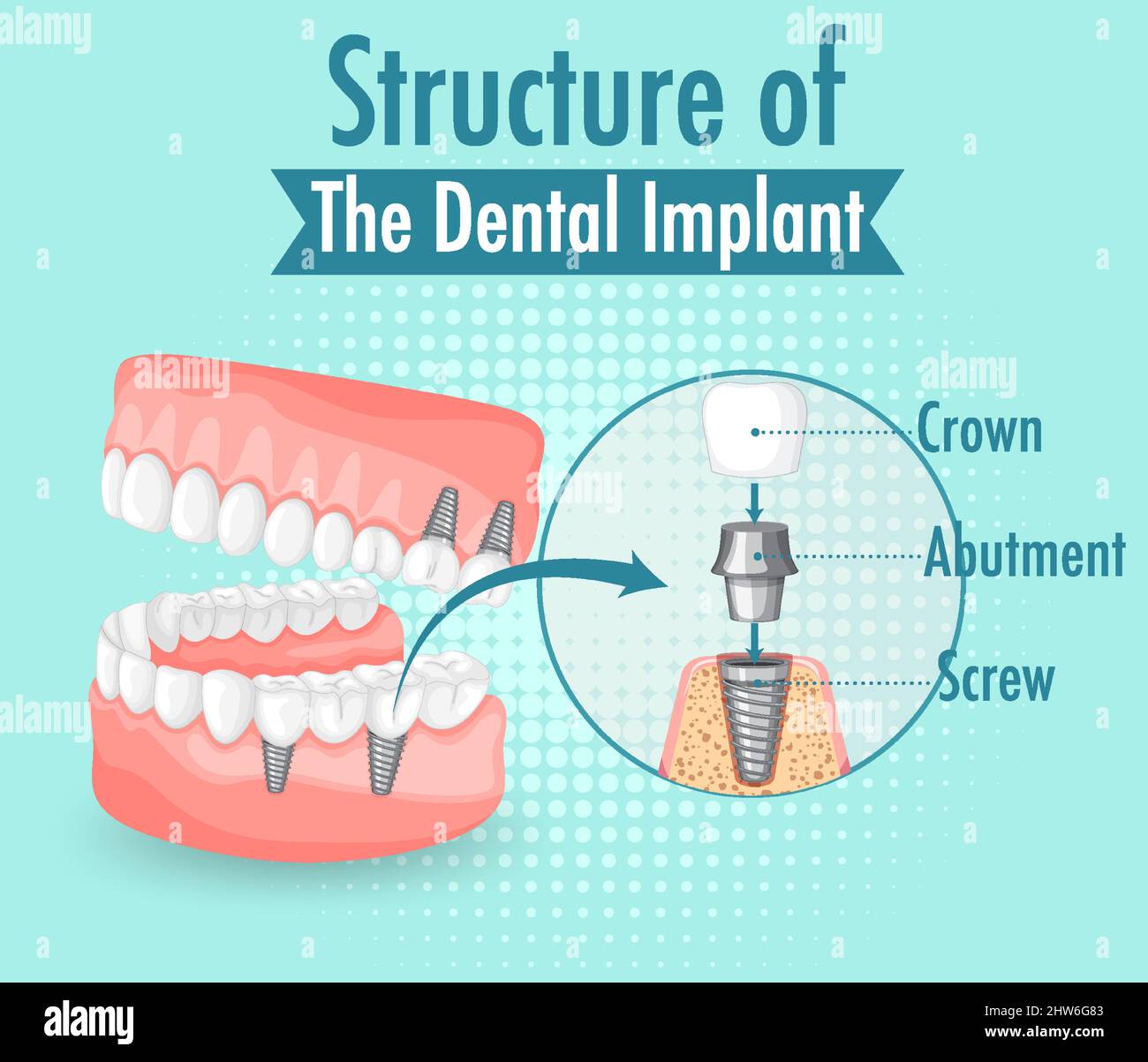 Infographic of human in structure of the dental implant illustration ...