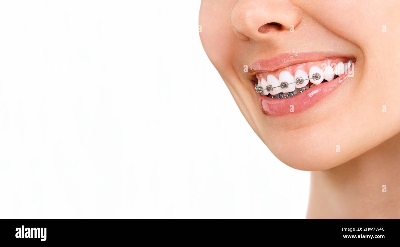Smile with Braces Orthodontic Treatment. Dental Care Concept. Beautiful ...