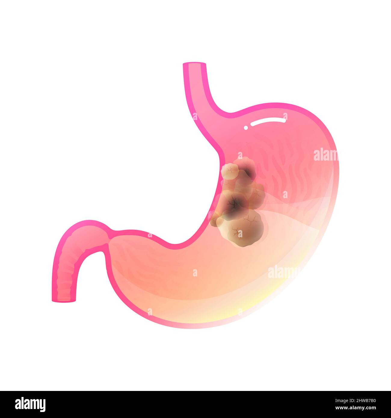 Human stomach helicobacter pylori Cut Out Stock Images & Pictures - Alamy