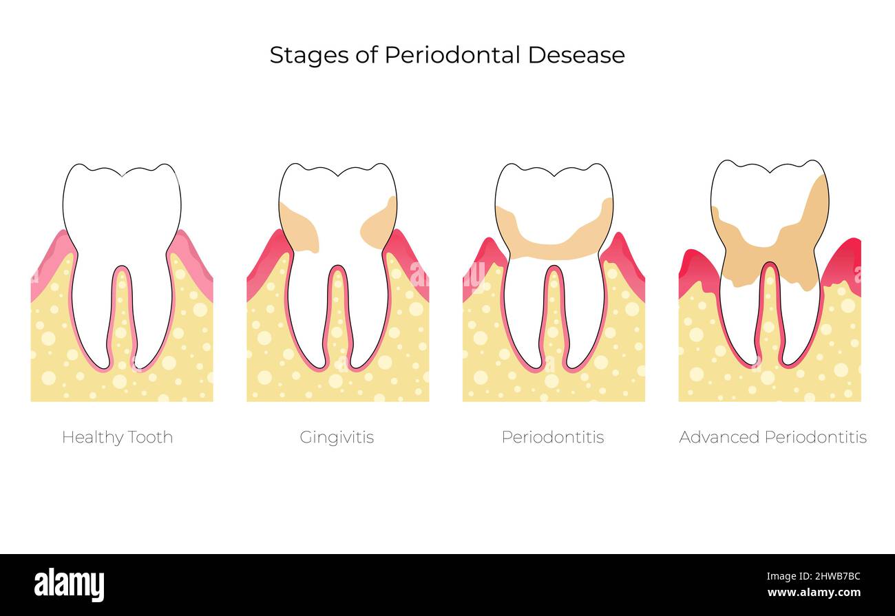 Stages of periodontal disease, illustration Stock Photo - Alamy
